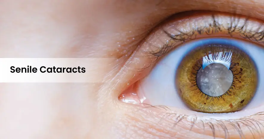 Senile Cataracts : Causes, Symptoms and Ayurvedic Remedies
